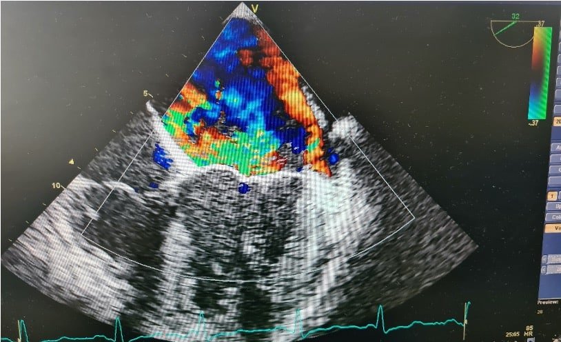 Transesophageal Echocardiography | Dr. Antonis Ioannou — Cardiologist ...